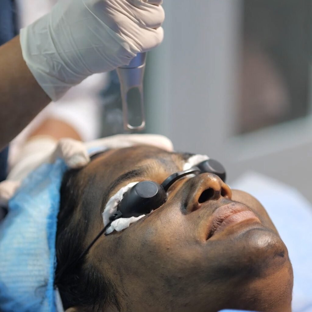 Radiant Skin: Carbon Laser Peel At Dermavue
